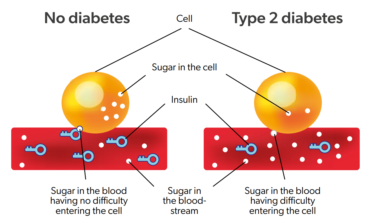 What is diabetes? | Diabetes Québec